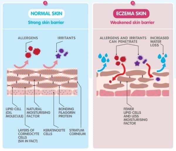 Find out more about filaggrin | National Eczema Society